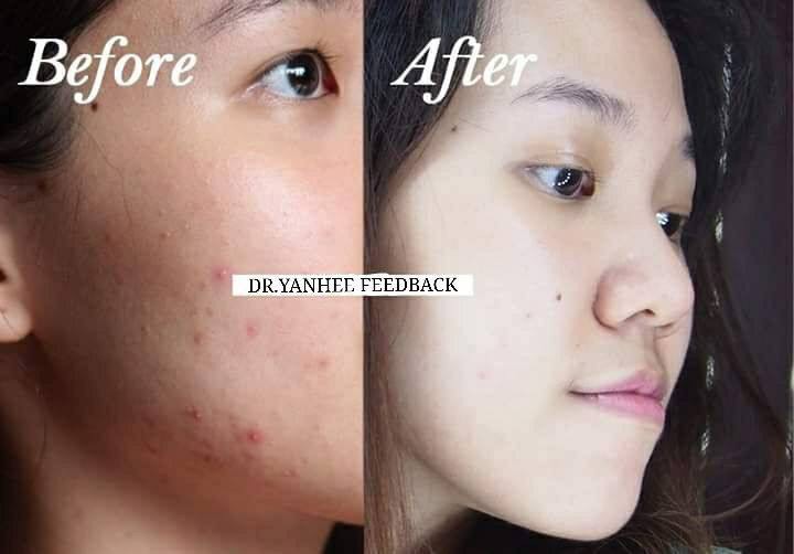 Dr. Yanhee Creams Set melasma | Worldwide Shipping | Retail & Wholesale