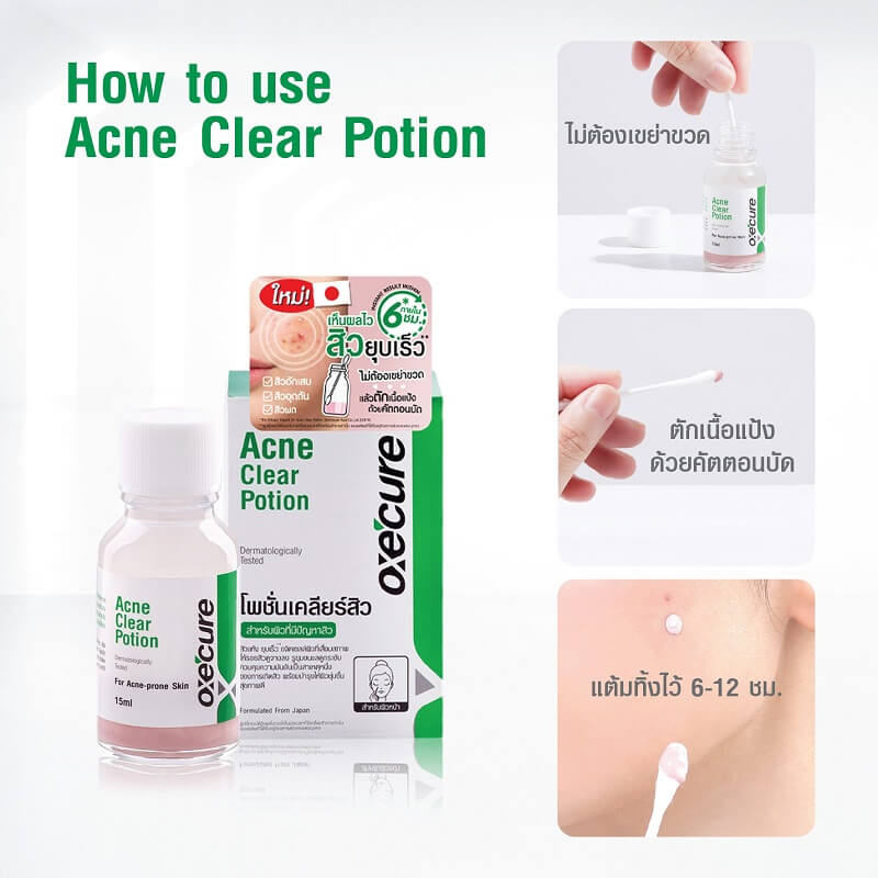 Oxe Cure Acne Clear Potion | Worldwide Shipping | Retail Wholesale